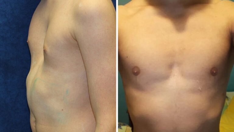 What Are the Causes of Flared Ribs, and How Can They Be Prevented ...