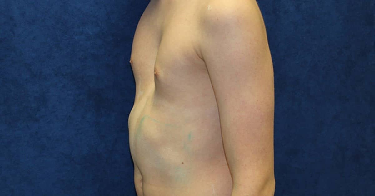 15 Natural Remedies and Stretches to Ease Flared Rib Pain - Theresa Reviews